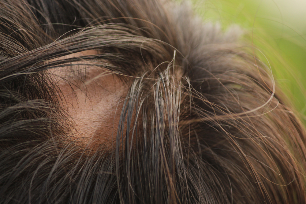 Hair Loss And Traditional Chinese Medicine - welleum